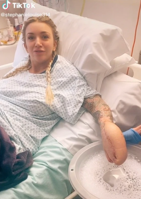 Woman Left With "Shark Hand" After It Was Sewed Inside Stomach During ...