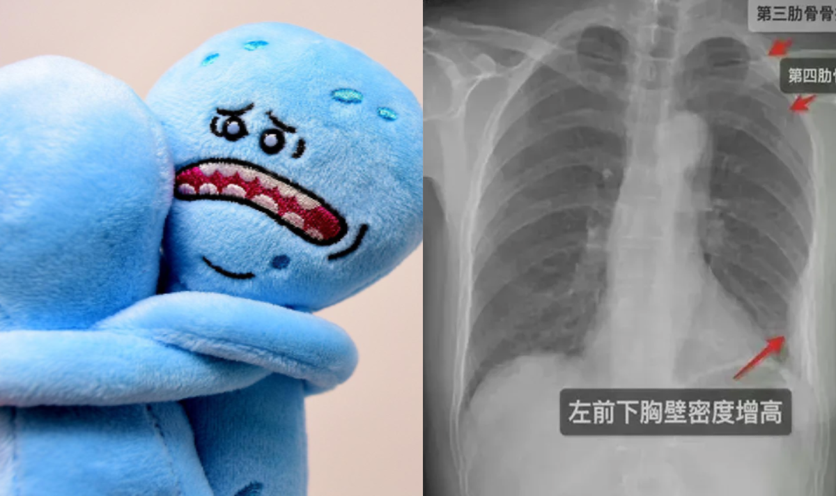 Woman Sues Her Coworker For Breaking Her Ribs While Giving A Hug ...