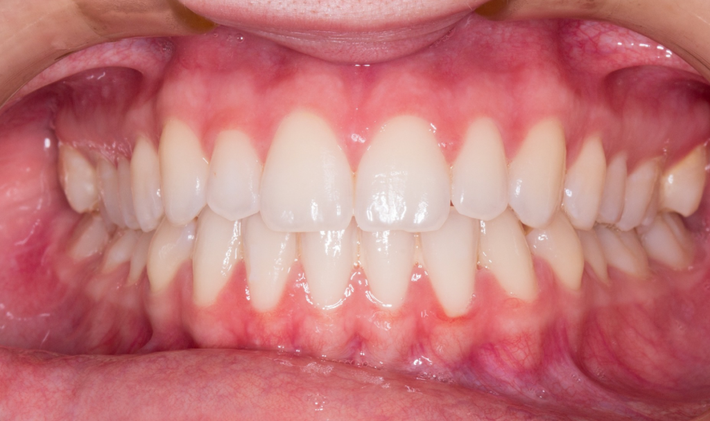 Man Pulls His Teeth Within Ten Years Because He Can t Get A Dentist Man Pulls His Teeth Within Ten Years Because He Can t Get A Dentist