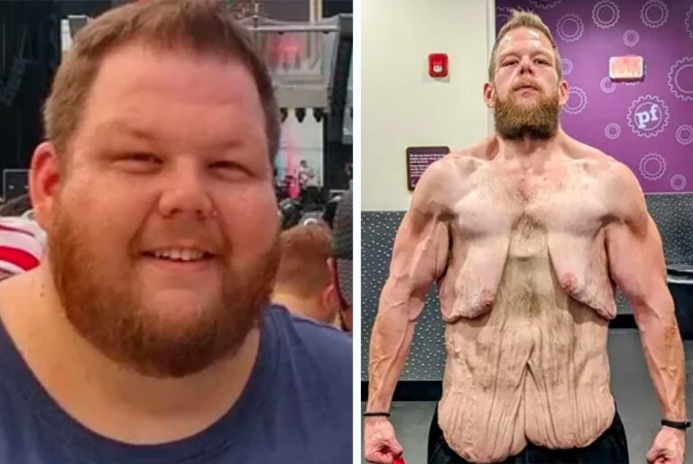 Man Shares Touching Story Of His Struggle With Excess Skin After Losing ...