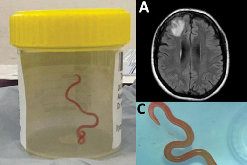 Doctors Remove Live 3-Inch Parasitic Worm From Woman’s Brain In World’s ...