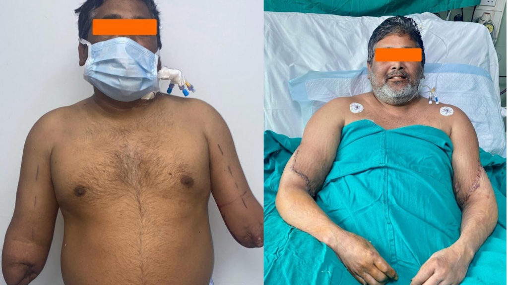 Delhi Artist Receives Double Hand Transplant Through Organ Donation ...